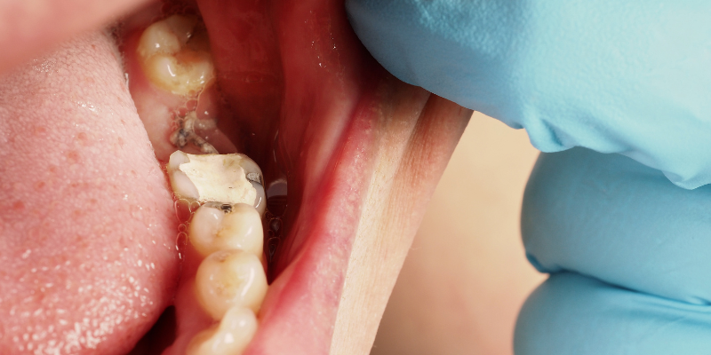 How Dentists Treat Cavities with Restorative Dentistry